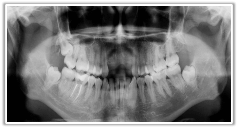 Halo Dental Inc. – Safe, Affordable Expert Wisdom Tooth Removal