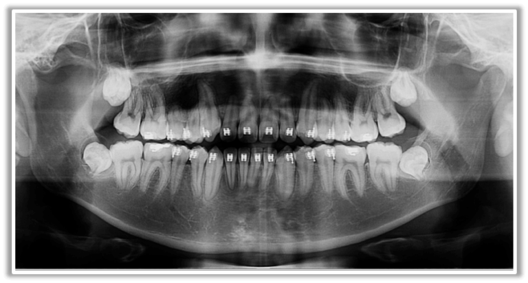 Halo Dental Inc. – Safe, Affordable Expert Wisdom Tooth Removal